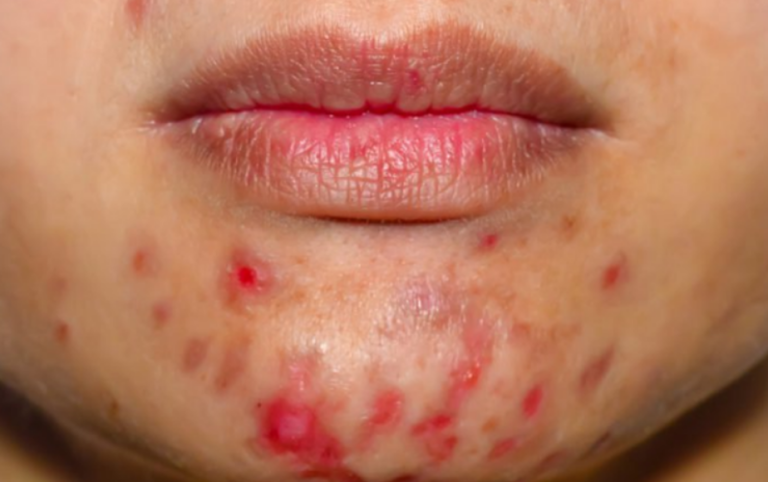 Arti Letak Jerawat di Wajah - Penyebab, Makna, dan Cara Mengatasinya